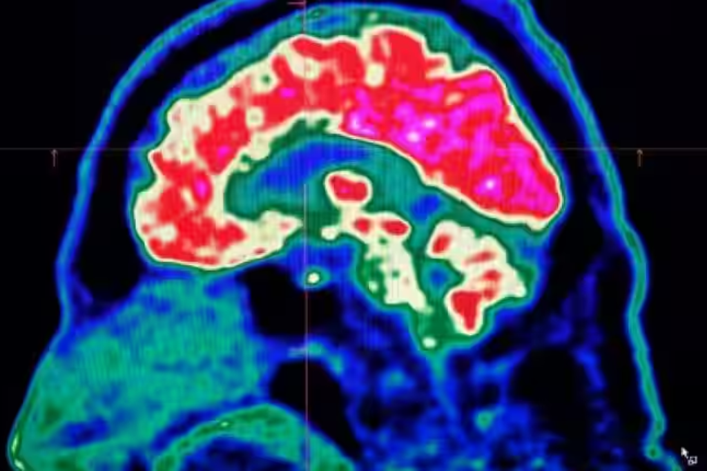 Does the Brain Eat Itself from Lack of Sleep? – Xorvex